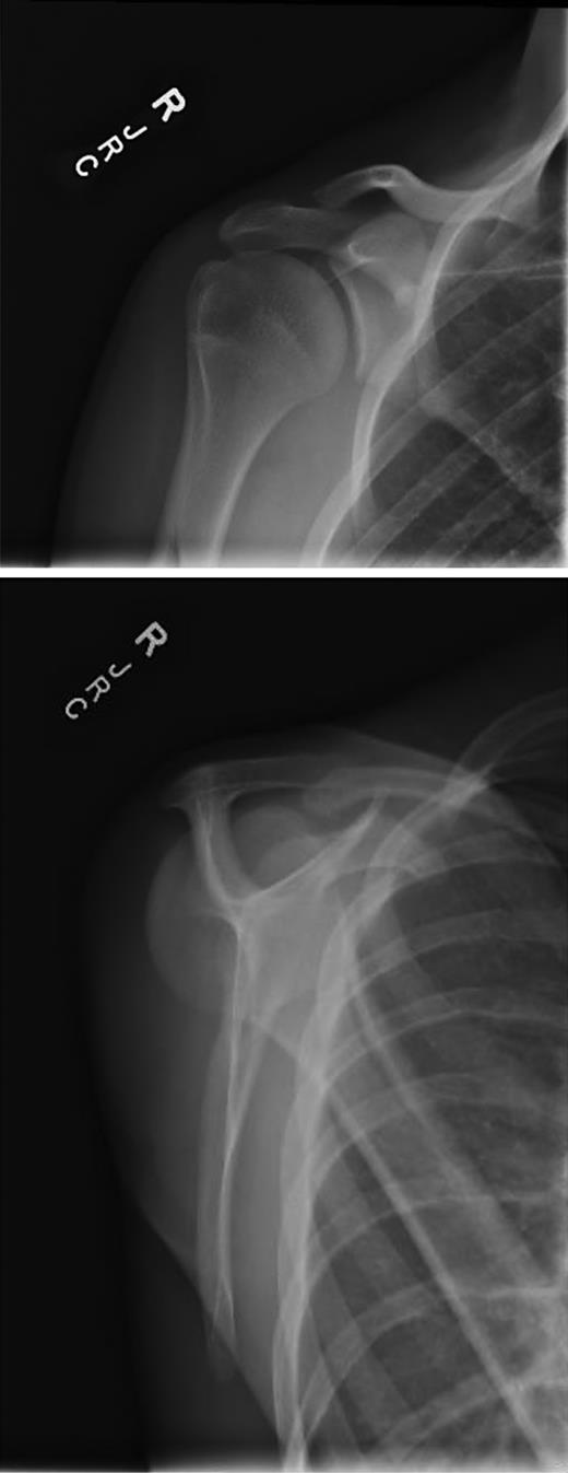 Bilateral Acromioclavicular Joint Subluxation in an Adolescent with ...