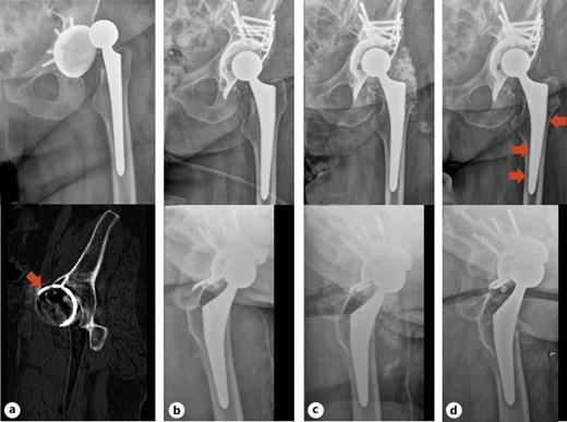 Haematogenous Periprosthetic Hip Joint Infection Caused by Salmonella ...