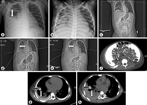 Effective Management of Peritoneal Dialysis-Associated Hydrothorax in a ...