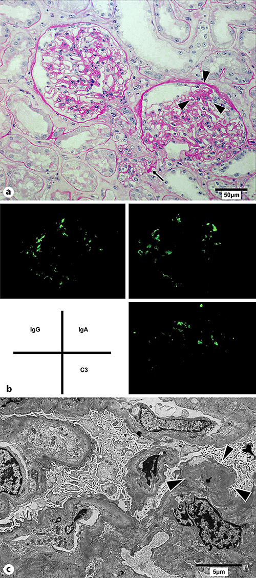 Acute Kidney Injury Associated with Minimal Change Nephrotic Syndrome ...