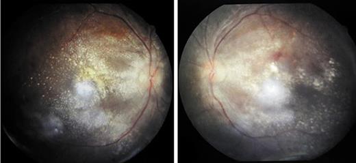 Uremic Optic Neuropathy: A Potentially Reversible Complication of ...