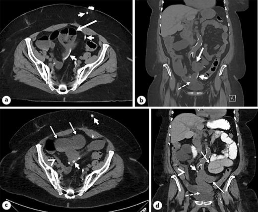 Small Bowel Obstruction with a Transition Point in a Patient on ...