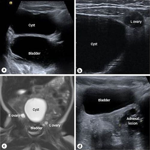 A Case of Multicystic Dysplastic Kidney Presenting as a Single Midline ...