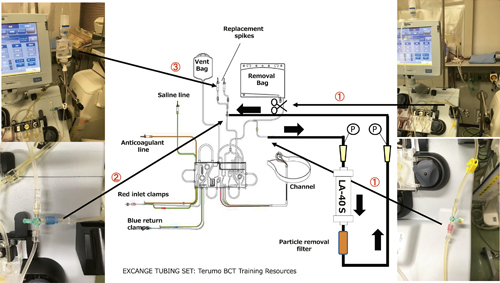 Low-Density Lipoprotein Adsorption by Centrifugal Plasma Separation Can ...