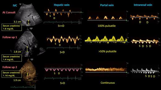 Venous Excess Doppler Ultrasound: A Visual Guide to Decongestion in ...