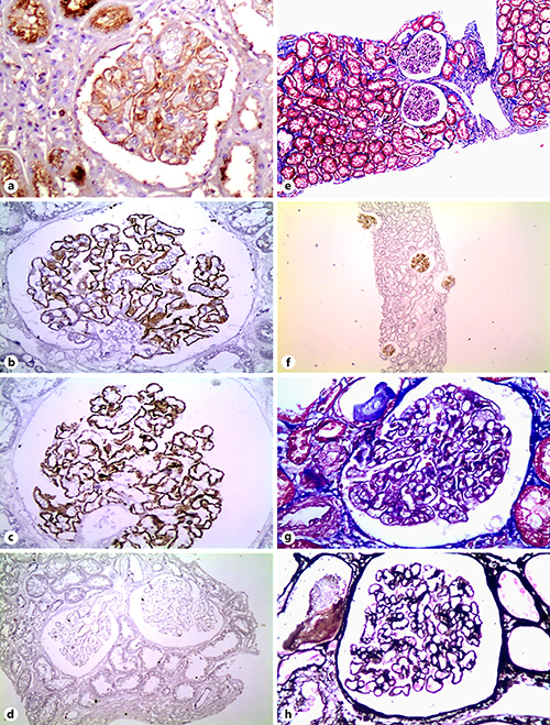 PLA2R-Negative Membranous Nephropathy Presenting as a Prodrome of IgG4 ...