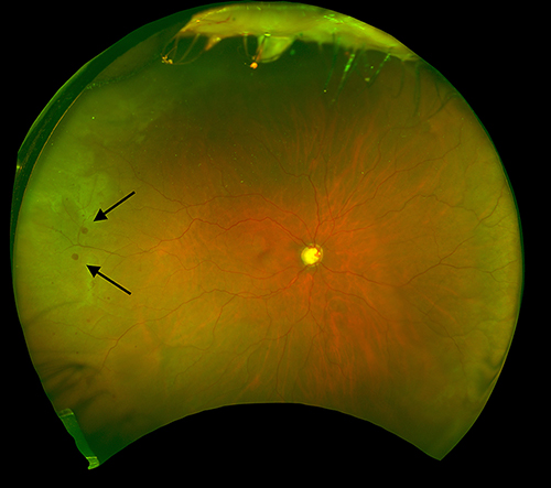 Immediate Manifestation of Ocular Decompression Retinopathy following ...