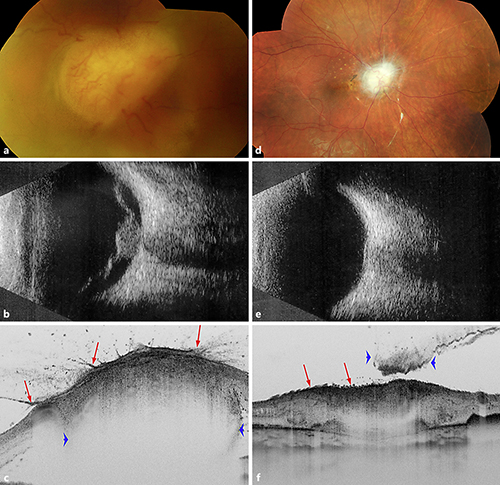 Toxocara Optic Disc Granuloma: Deep Range Imaging Optical Coherence ...