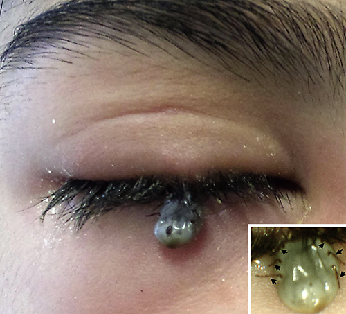 Large Tick (Ixodes) Infestation of the Upper Eyelid Presenting as ...