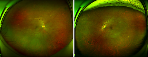 Intravitreal Voriconazole for Treatment of Bilateral Endogenous Candida Chorioretinitis | Case ...