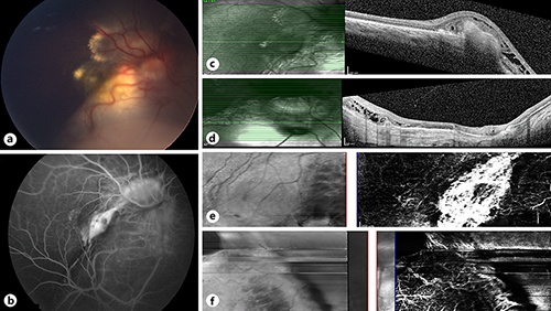 Multimodal Imaging of Large Optic Disc Coloboma: A Report of Three ...