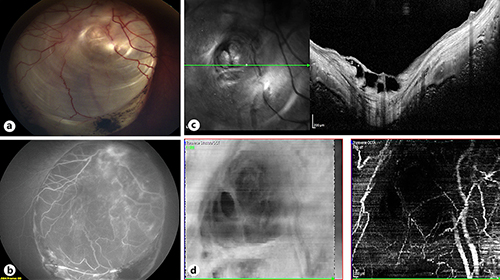 Multimodal Imaging of Large Optic Disc Coloboma: A Report of Three ...