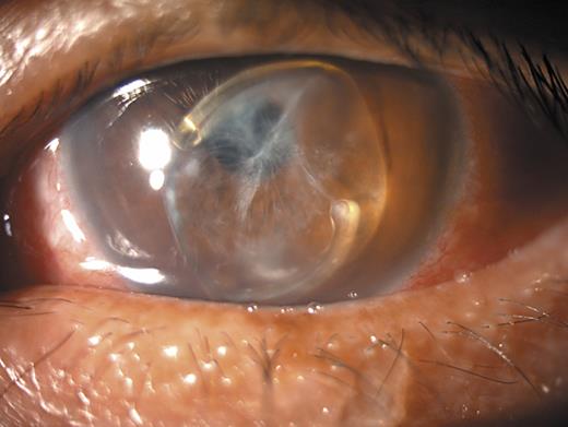 Late Nontraumatic Anterior Dislocation of Intraocular Lens with ...