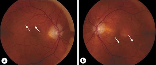 Multimodal Imaging in a Case with Bilateral Choroidal Folds | Case ...