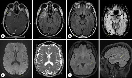 Migraine-Like Positive Visual Phenomena Related to Focal Cortical ...