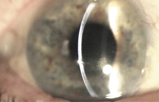 Reactivation of Herpes Zoster Keratitis Following Shingrix Vaccine ...