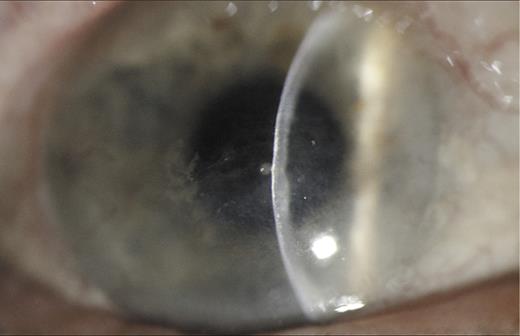 Reactivation of Herpes Zoster Keratitis Following Shingrix Vaccine ...
