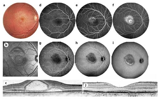 Multimodal Imaging of Unilateral Acute Maculopathy Associated with Hand ...