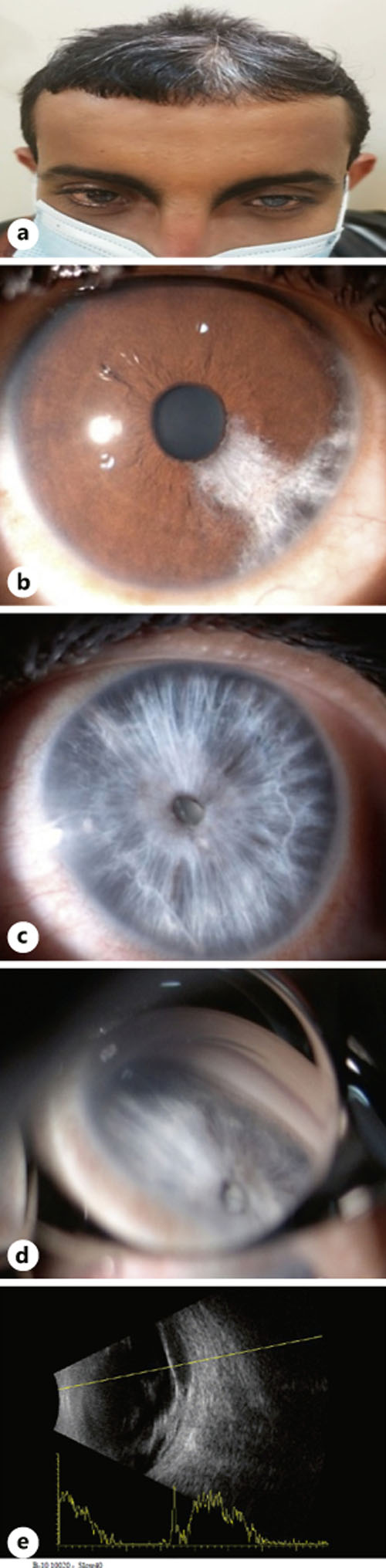 Unilateral High Intraocular Pressure, Cataract, and Retinal Detachment ...