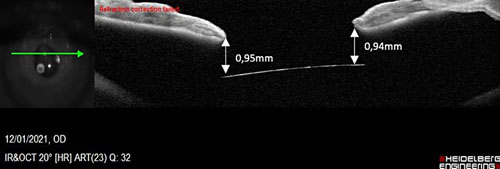 Anterior Chamber Dislocation of Dexamethasone Implant in the Presence ...