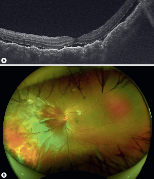Granulomatosis with Polyangiitis Complicated by Severe Exudative ...