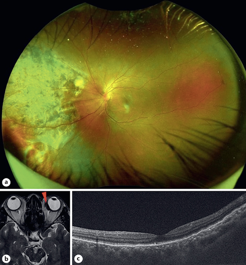 Granulomatosis with Polyangiitis Complicated by Severe Exudative ...