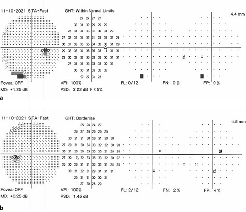 Concentric Reversible Visual Field Loss, Nyctalopia, and ...