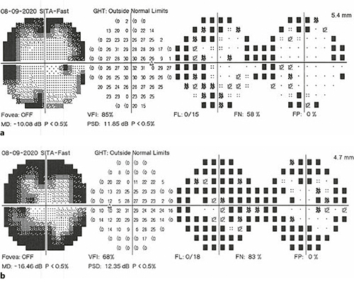 Concentric Reversible Visual Field Loss, Nyctalopia, and ...