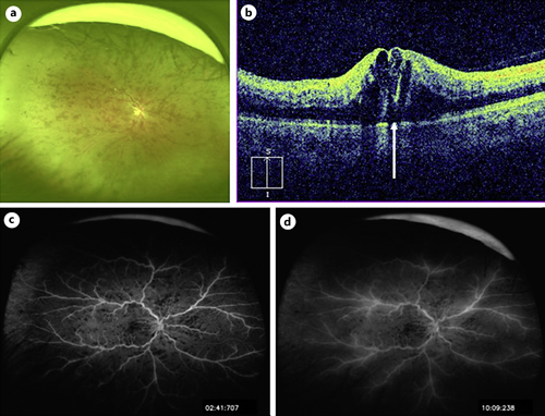 Central Retinal Vein Occlusion after mRNA COVID-19 Vaccination | Case ...