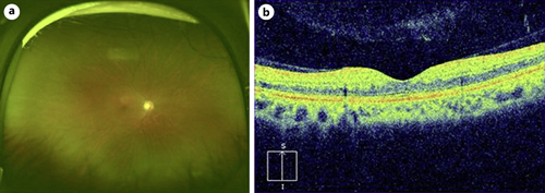 Central Retinal Vein Occlusion after mRNA COVID-19 Vaccination | Case ...