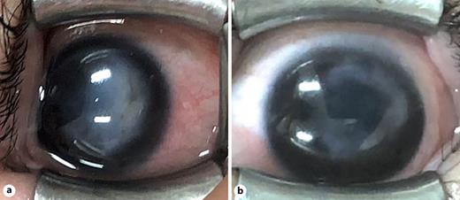 A Case of Autism Spectrum Disorder with Perforated Keratomalacia due to ...