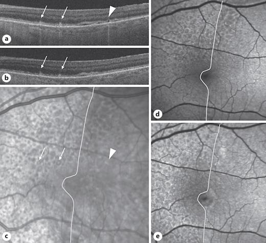 Reticular Pseudodrusen Voids after Rhegmatogenous Retinal Detachment ...