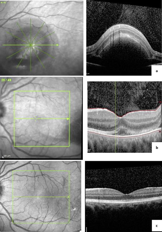 A Case of Traumatic Submacular Hemorrhage Treated with tPA and ...