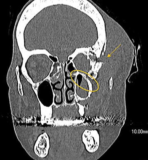 A Case of Osteopetrosis with Orbital Inflammation Secondary to ...
