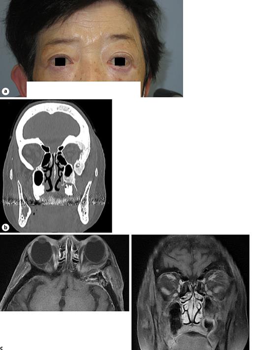 A Case of Osteopetrosis with Orbital Inflammation Secondary to ...