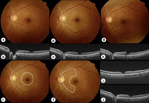 A Case of Closure of Recurrent Full-Thickness Macular Hole by ...