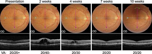 From Hair Loss to Vision Loss: Minoxidil-Associated CRVO in a Young ...