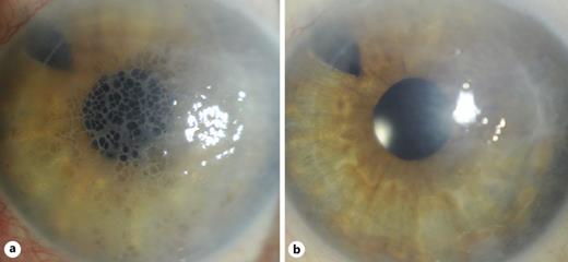 Reticular Bullous Epithelial Corneal Edema after Netarsudil Use for ...