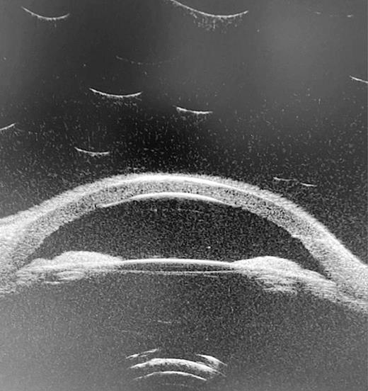 Pseudophakic Pupillary Block due to the Capsular Bag Intraocular Lens ...