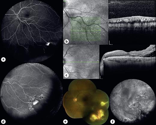 Vasoproliferative Retinal Tumors: Manifestations, Management, and ...