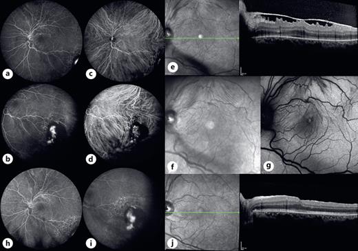 Vasoproliferative Retinal Tumors: Manifestations, Management, and ...