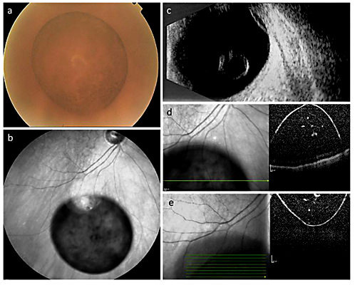Floating Vitreous Cyst: Two Clinical Cases | Case Reports in ...