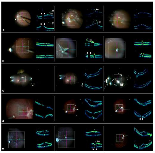 Intraoperative Optical Coherence Tomography-Assisted 27-Gauge ...