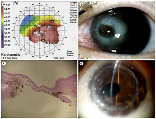 Corneal Melting after Collagen Cross-Linking for Keratoconus in a Thin ...
