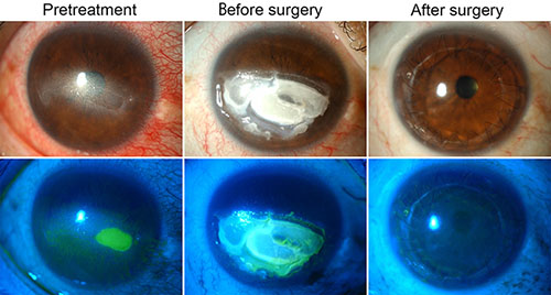 Remodeling of the Corneal Epithelial Scaffold for Treatment of ...