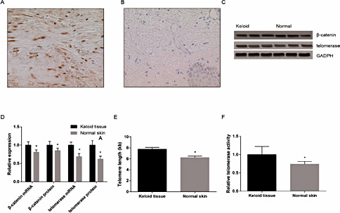Wnt/β-Catenin Signaling Exacerbates Keloid Cell Proliferation by ...