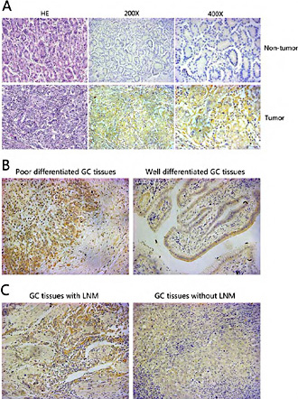 Overexpression of Lymphocyte Antigen 6 Complex, Locus E in Gastric ...
