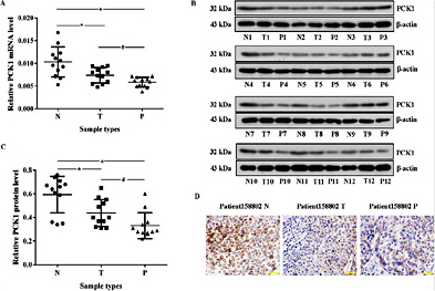 Overexpression of PCK1 Gene Antagonizes Hepatocellular Carcinoma ...