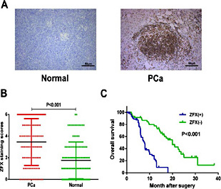ZFX Promotes Proliferation and Metastasis of Pancreatic Cancer Cells ...