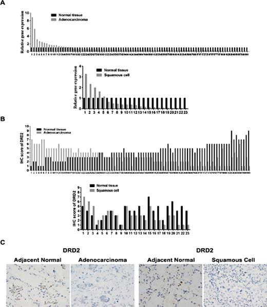 Overexpressed D2 Dopamine Receptor Inhibits Non-Small Cell Lung Cancer ...